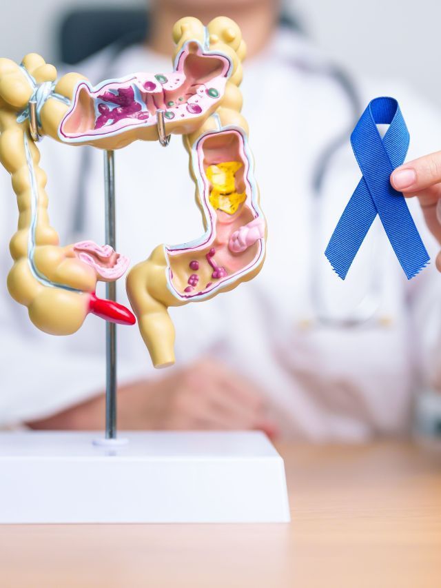 Câncer colorretal: saiba riscos, prevenção e tratamento | Web Stories ...