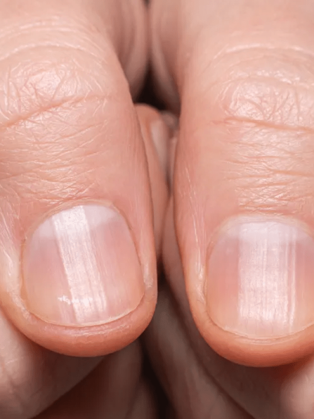Unhas estriadas: o que pode ser e como tratá-las – Web Stories CNN Brasil