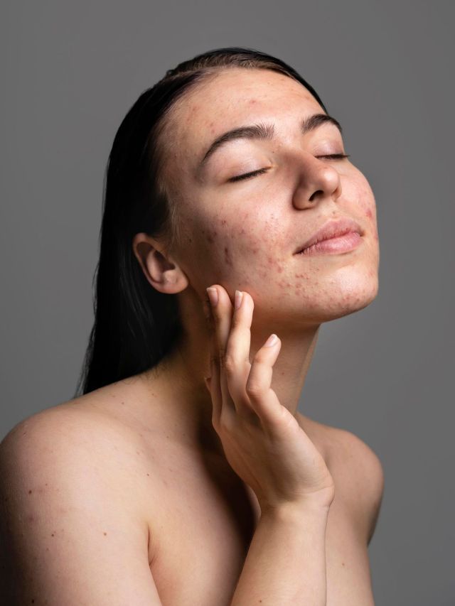 Acnes na adolescência: por que elas surgem e como lidar com elas | Web ...